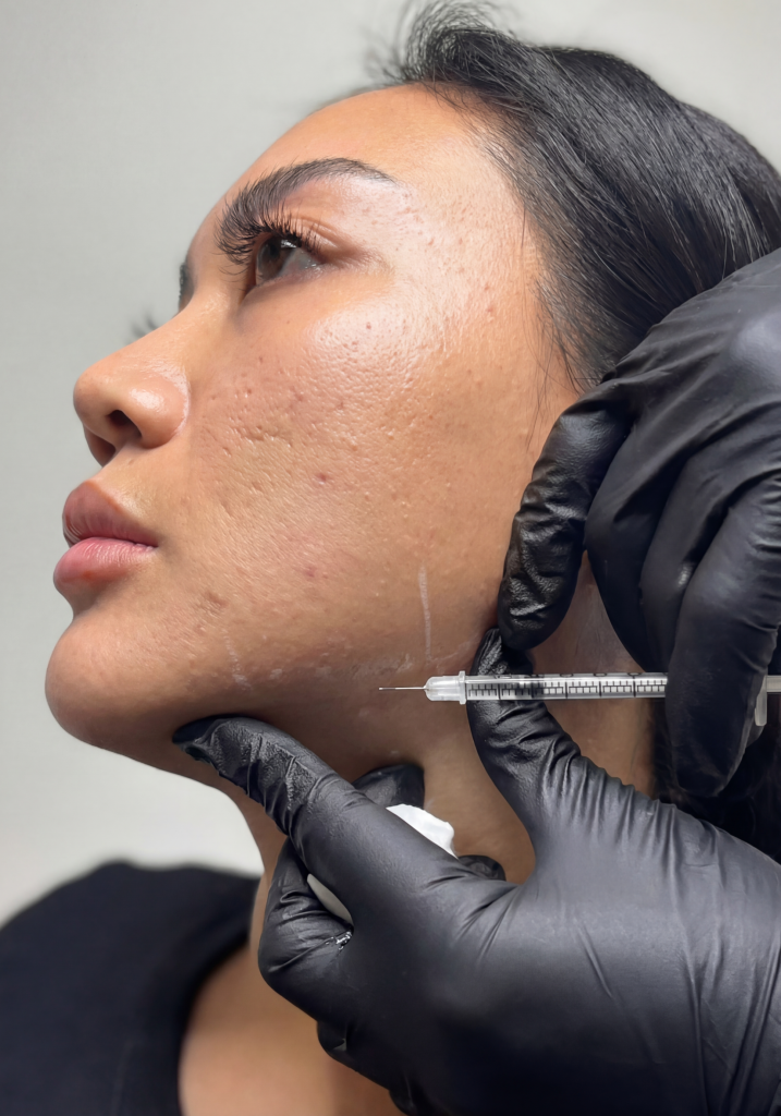 Neurotoxins Treatments Toronto | 30 Hazelton